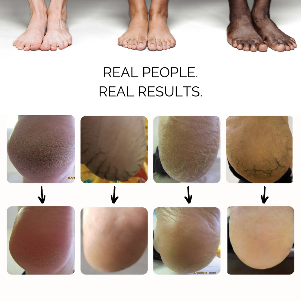 Dermatonics - For Feet Worth Flaunting